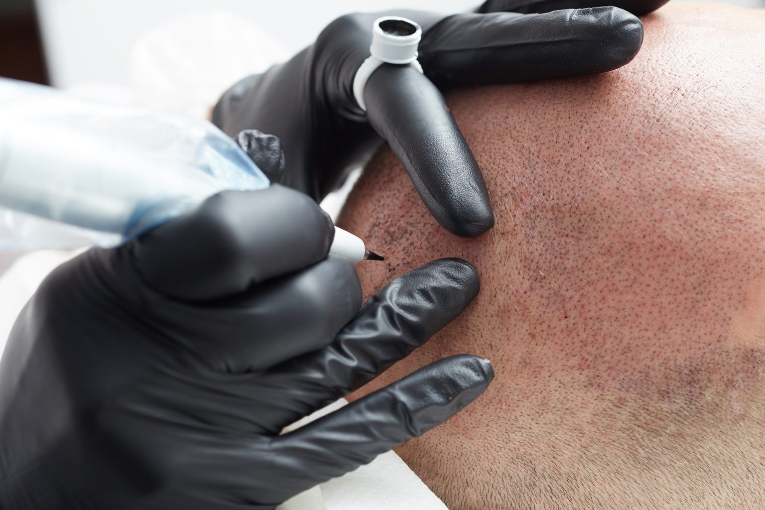 Scalp Micropigmentation Treatment in Brisbane & Toowoomba